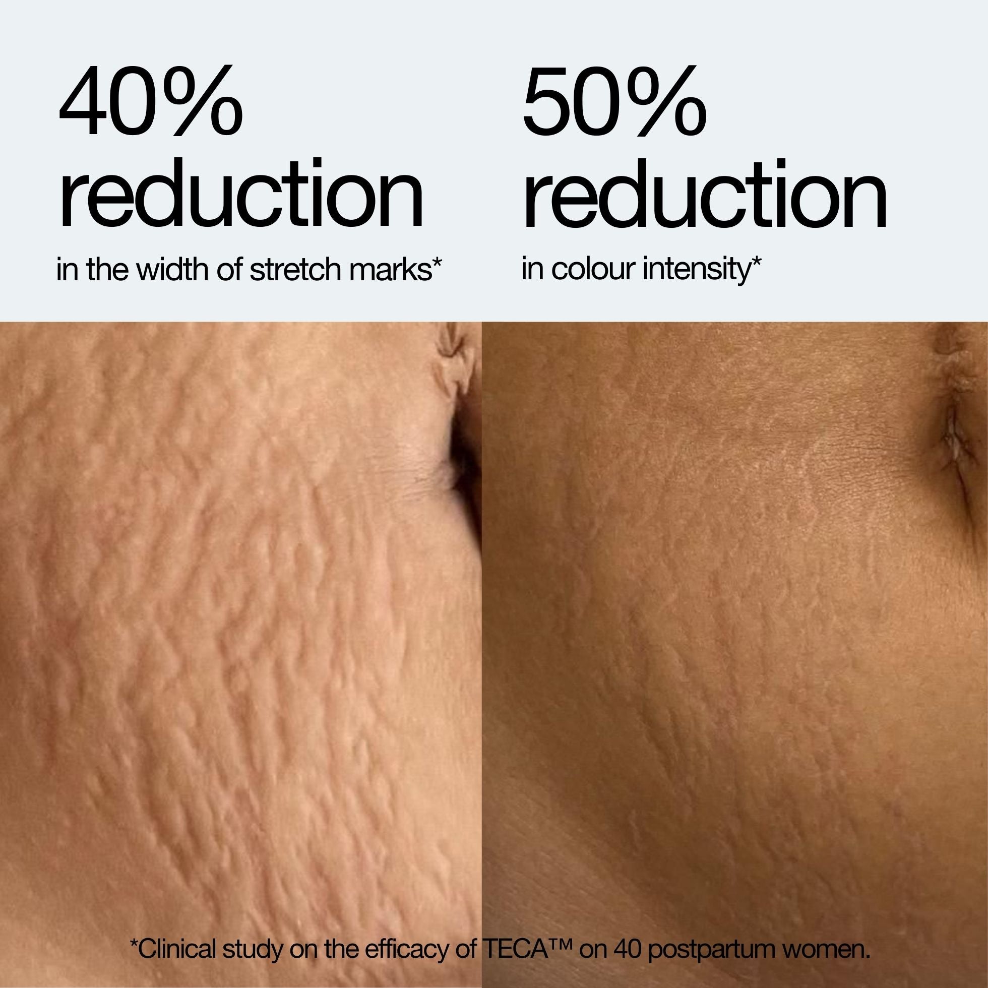 Stretch Mark Repair Programme