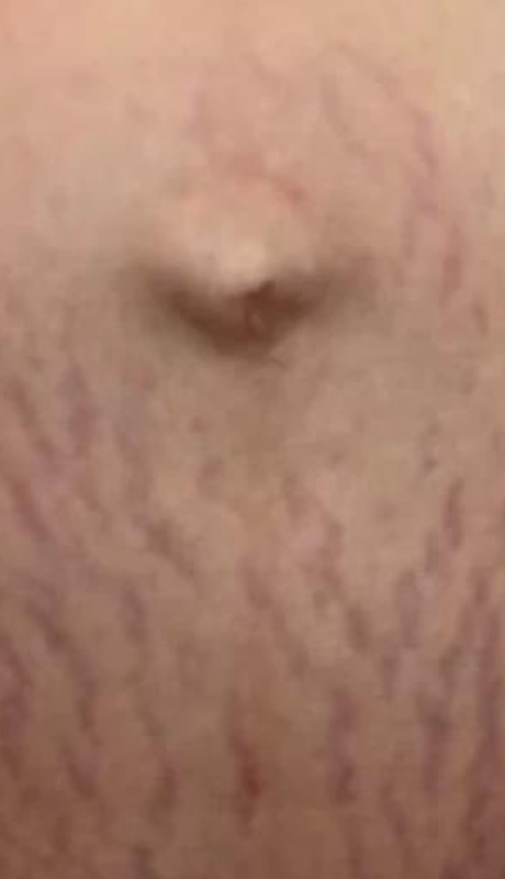 Curative Solutions for Stretch Mark Removal | Striā Lab
